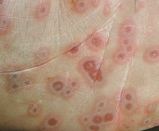 Erythema Migrans Vs Erythema Multiforme