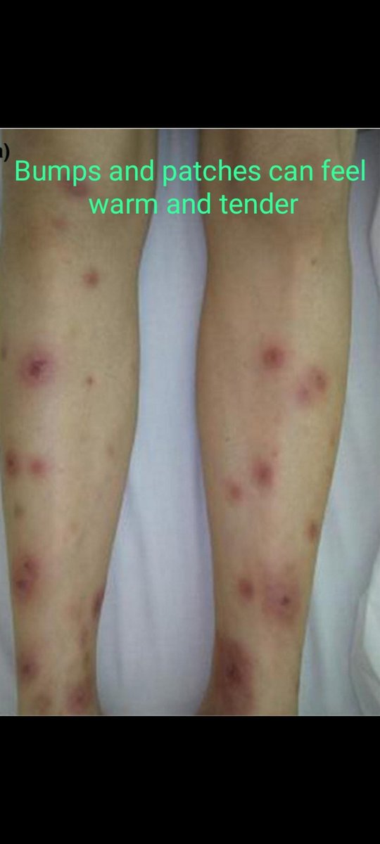 📍Erythema 𝗺𝗮𝗿𝗴𝗶𝗻𝗮𝘁𝘂𝗺 vs 📍Erythema 𝗺𝗶𝗴𝗿𝗮𝗻𝘀 vs 📍Erythema 𝗶𝗻𝗳𝗲𝗰𝘁𝗶𝗼𝘀𝘂𝗺 vs 📍 ...