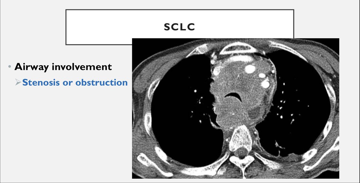 Male patient 50 years old. What is the type of lung cancer? What is ...