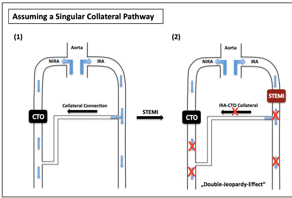 Infarct-Related Artery as a Donor of Collaterals in ST Segment ...