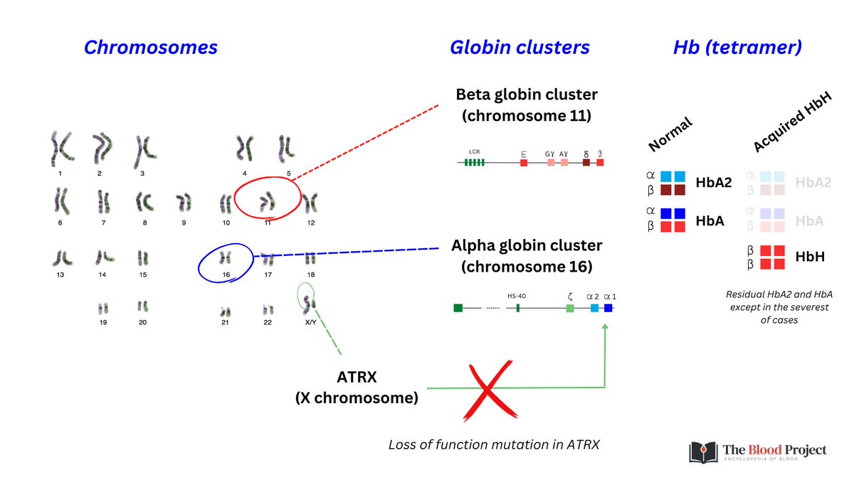 1/6 ACQUIRED HbH DISEASE I tweeted a CBC time series last week that ...