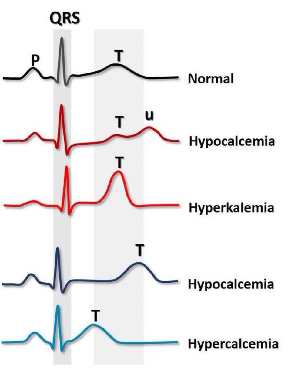Hypokalemia Hyperkalemia Ecg