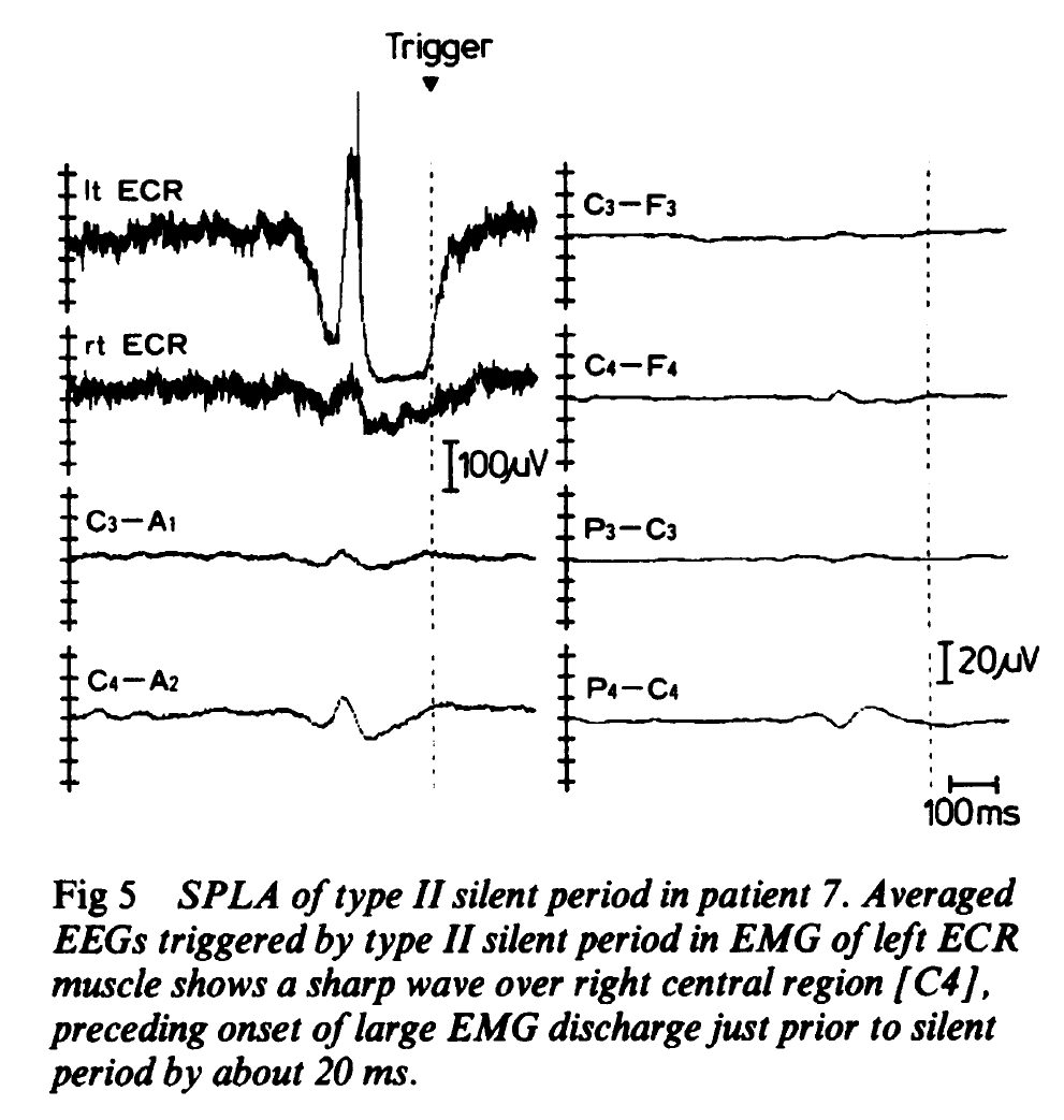 SEIZURE SEMIOLOGY TWEETORIAL #Epilepsy #Seizure #Neurotwitter 🧵/1 What ...
