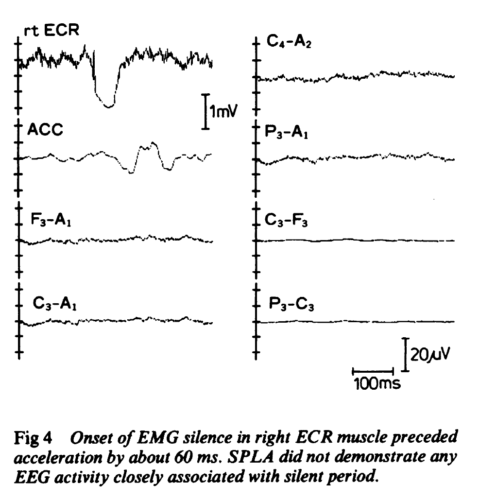 SEIZURE SEMIOLOGY TWEETORIAL #Epilepsy #Seizure #Neurotwitter 🧵/1 What ...