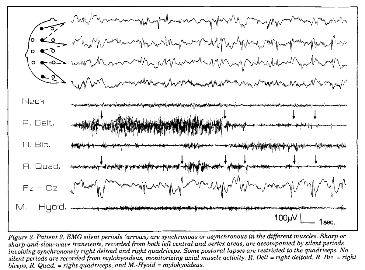 SEIZURE SEMIOLOGY TWEETORIAL #Epilepsy #Seizure #Neurotwitter 🧵/1 What ...