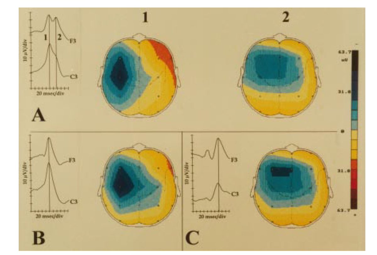 SEIZURE SEMIOLOGY TWEETORIAL #Epilepsy #Seizure #Neurotwitter 🧵/1 What ...