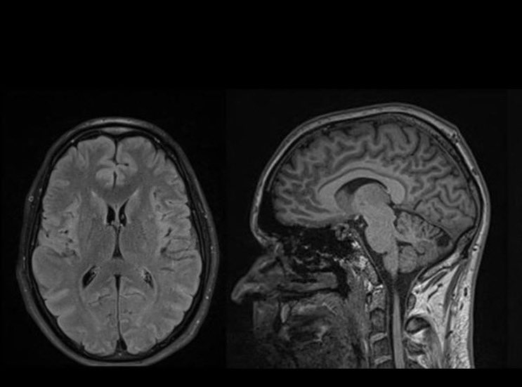 Mentally Challenged Brain