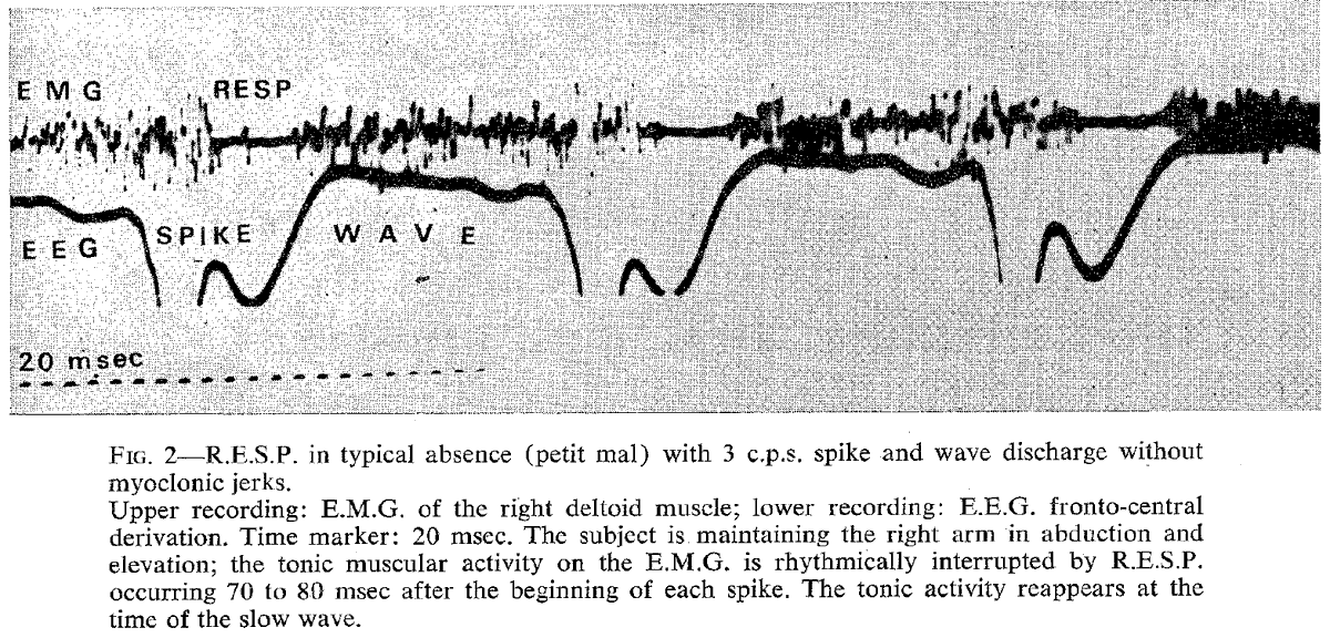 SEIZURE SEMIOLOGY TWEETORIAL #Epilepsy #Seizure #Neurotwitter 🧵/1 What ...