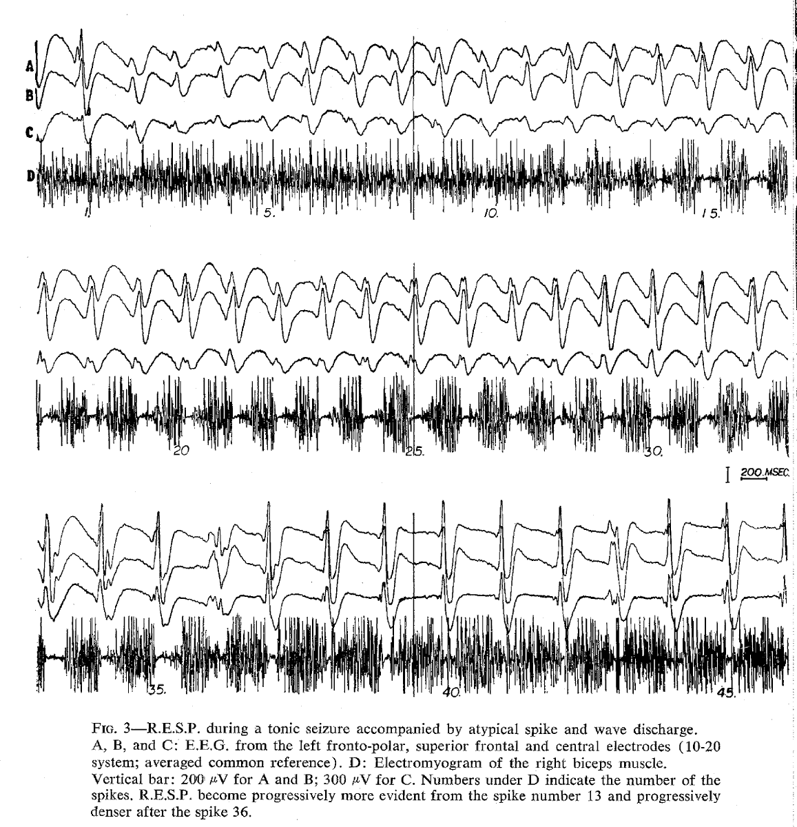 SEIZURE SEMIOLOGY TWEETORIAL #Epilepsy #Seizure #Neurotwitter 🧵/1 What ...