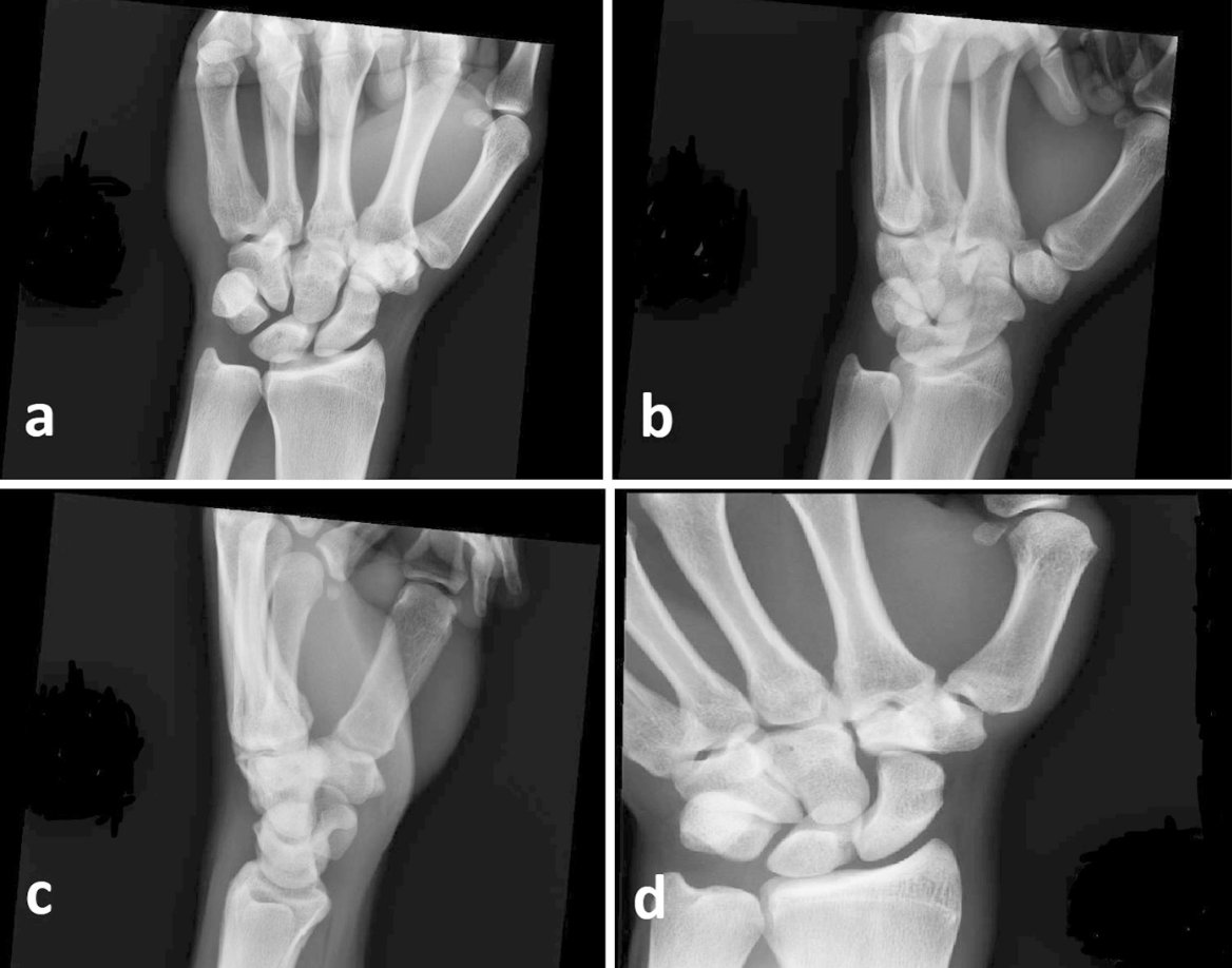 Trapezoid Bone Fracture