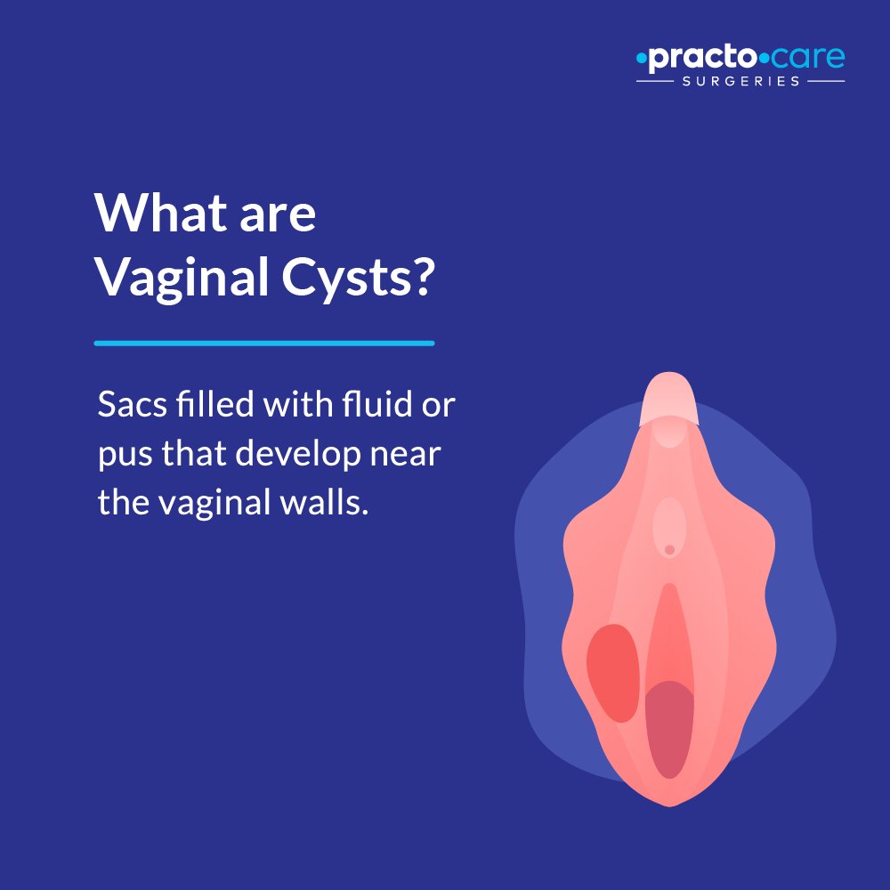 Vaginal Cyst