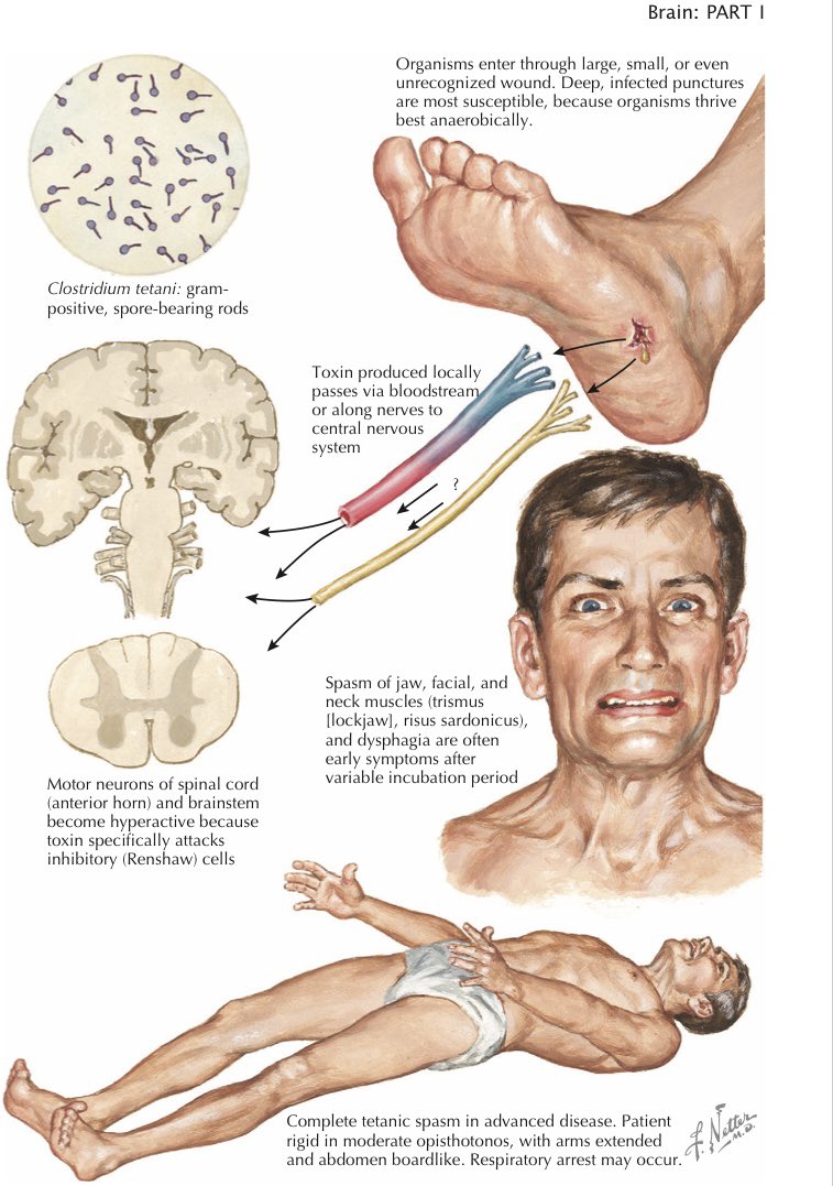 Clostridium Tetani Symptoms