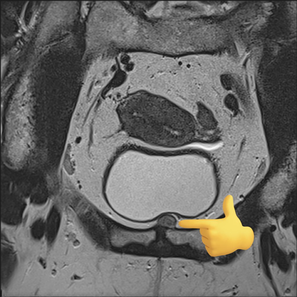 MR requested for study of anterior bladder wall bulging seen on ...