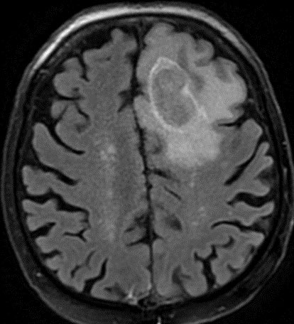 Tumors and tumor mimics can be incredibly difficult to interpret. Here ...