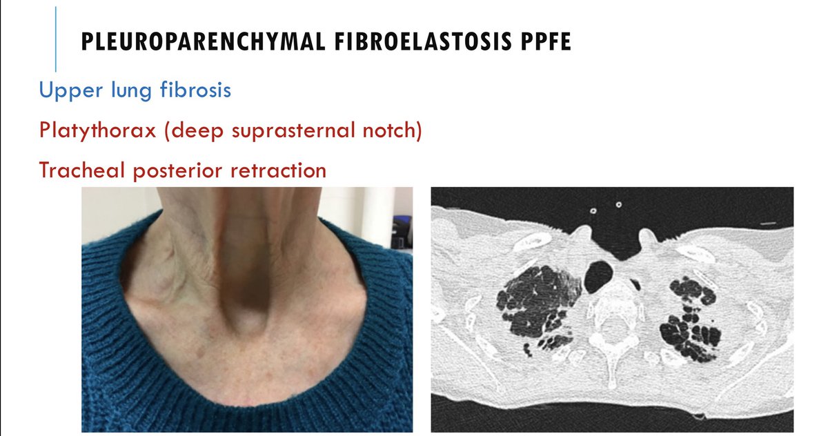 Female 53 years old. What is the cause of fibrosing lung disease ...