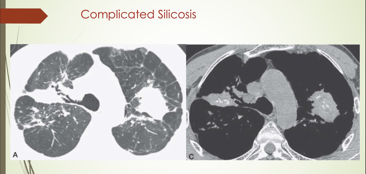 Female 53 years old. What is the cause of fibrosing lung disease ...