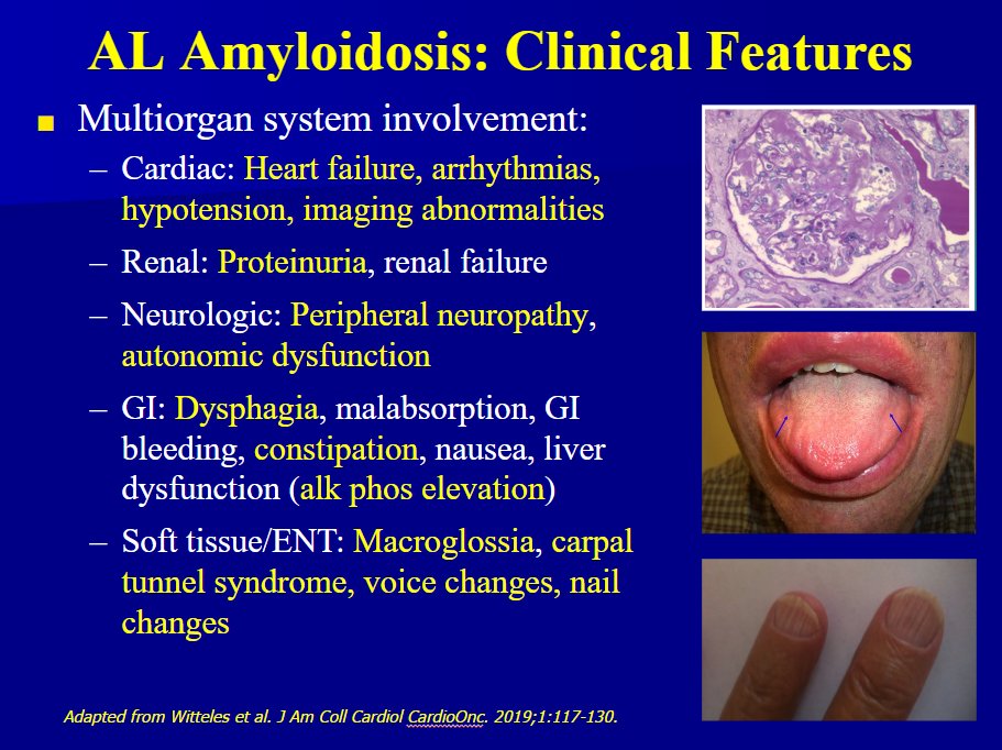 Amiloidosis Por Macroglosia