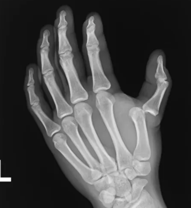 Radrounds Radiology Network On Twitter What Is The Diagnosis Answer