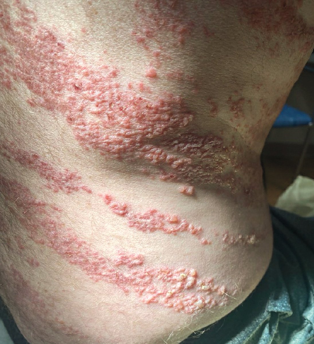 69 year old Man 1 week History Of An Itchy Burning Rash On His Back 69-year-old-man-1-week-history-of-an-itchy-burning-rash-on-his-back