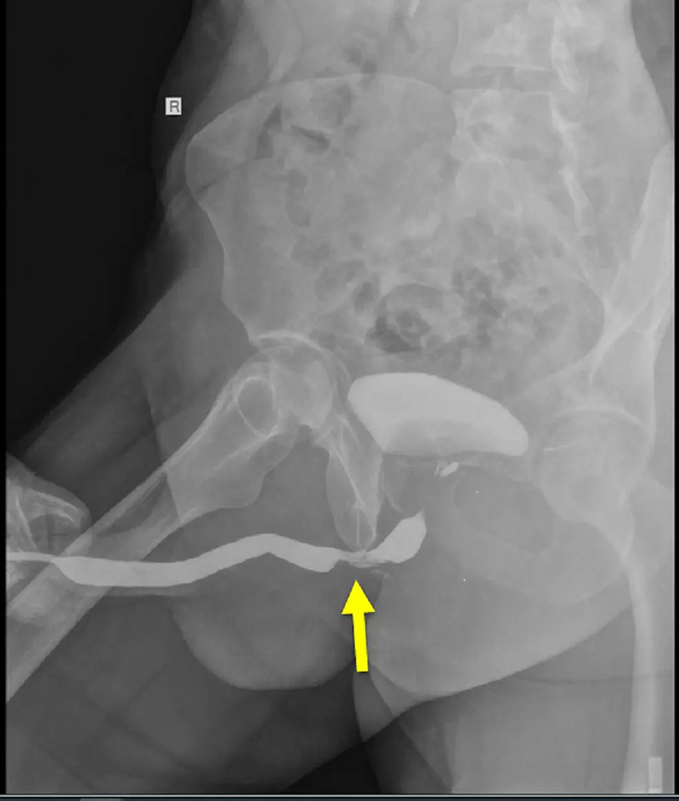 URETHRAL STRICTURE. Refers to the narrowing of the urethra (the tube ...