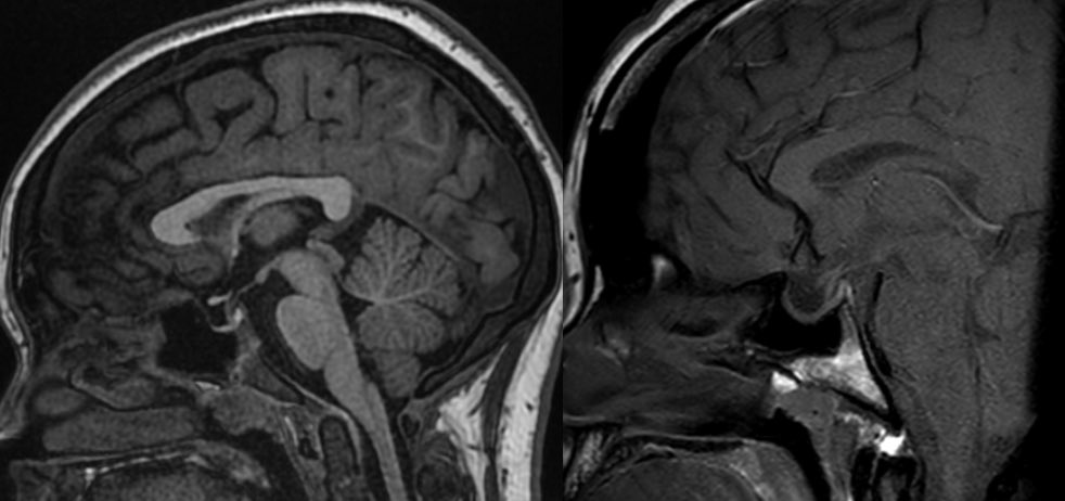 Supportive imaging findings of idiopathic intracranial hypertension ...