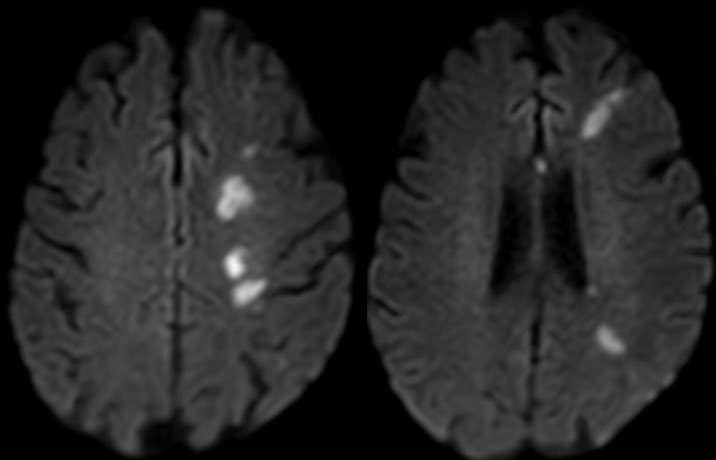 Imaging of Moyamoya disease/syndrome Imaging: Thread-like intracranial ...