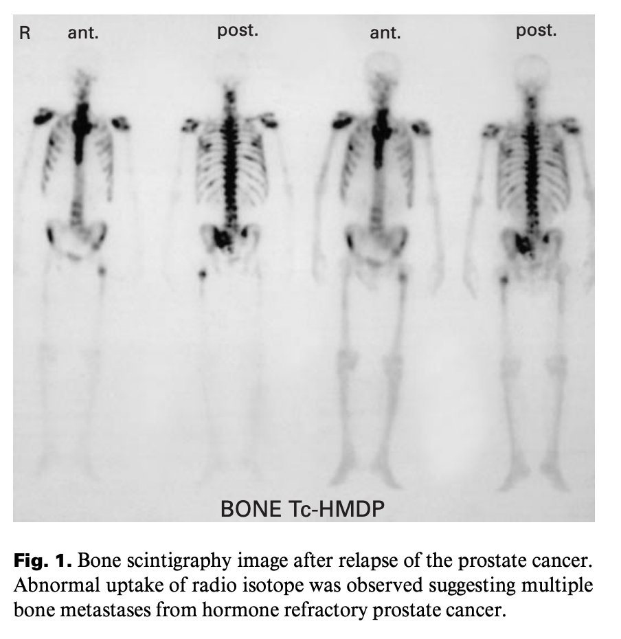 Three amazing cases of tumour regression with the use of Phellinus ...