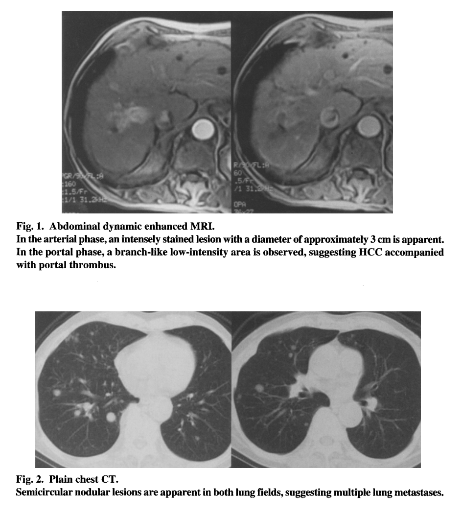 Three amazing cases of tumour regression with the use of Phellinus ...