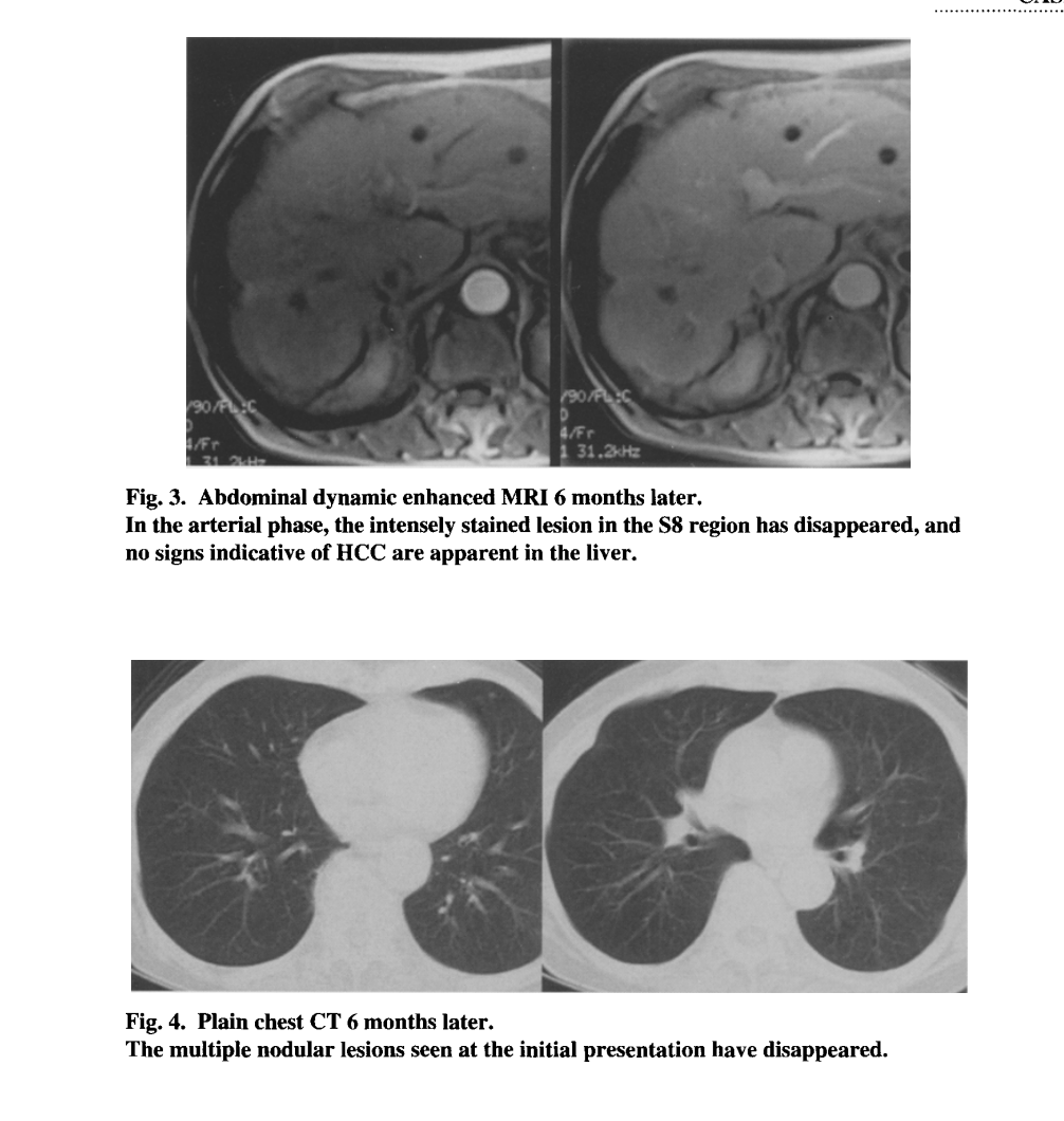 Three amazing cases of tumour regression with the use of Phellinus ...