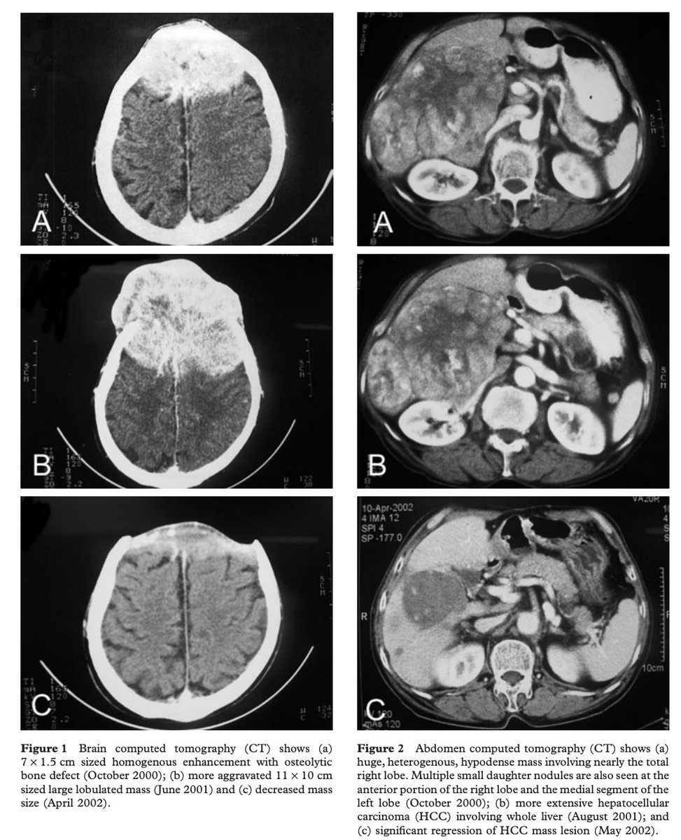 Three amazing cases of tumour regression with the use of Phellinus ...