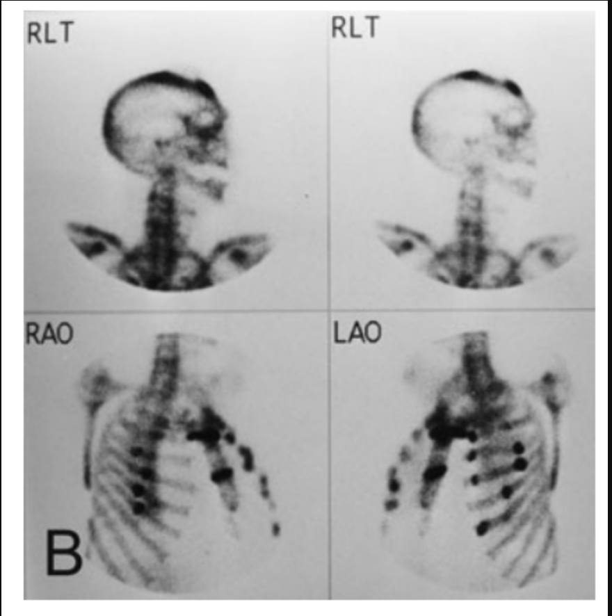 Three amazing cases of tumour regression with the use of Phellinus ...