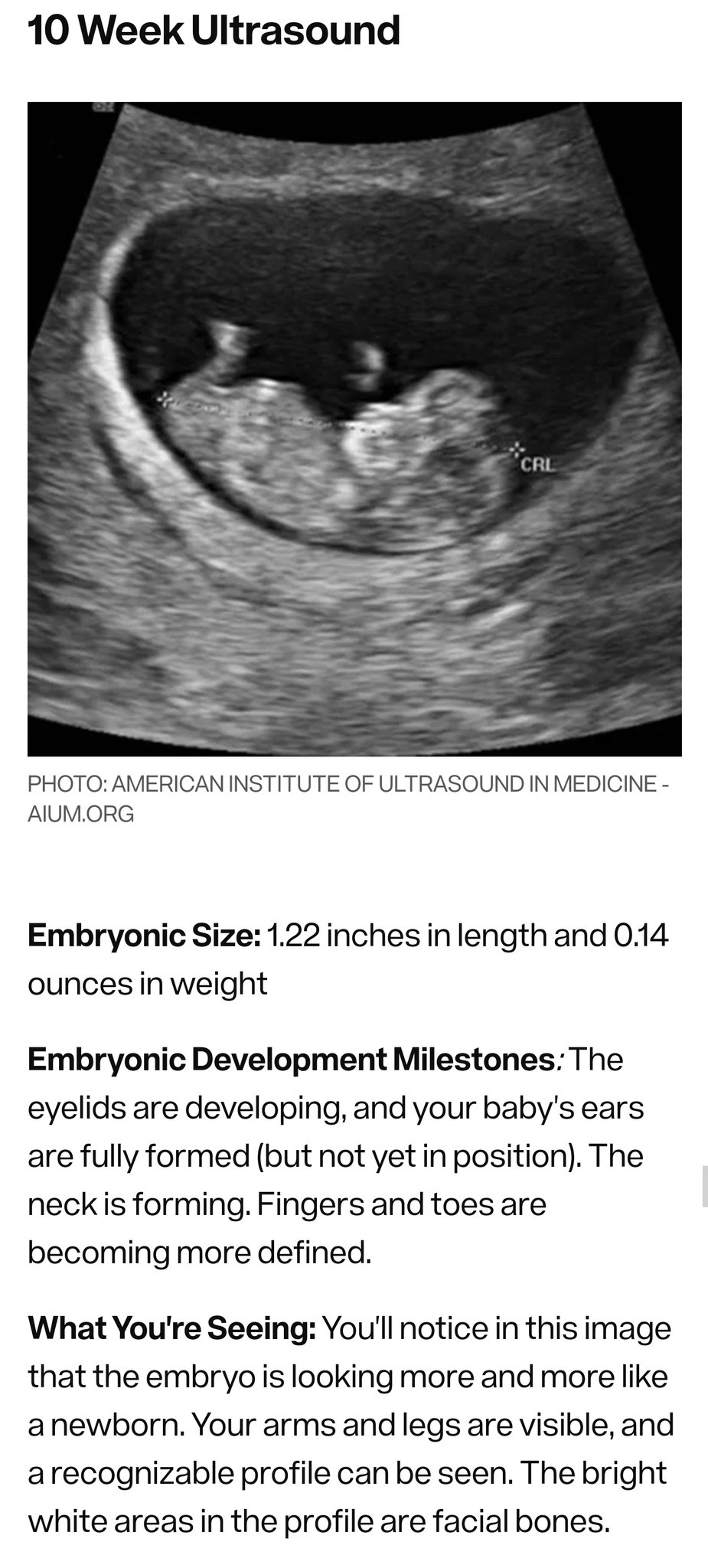 10 Week Ultrasound Pictures