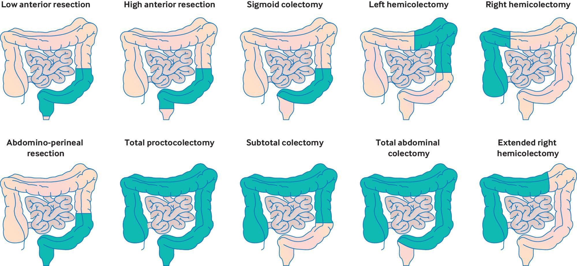 Low Anterior Resection Low Anterior Resection