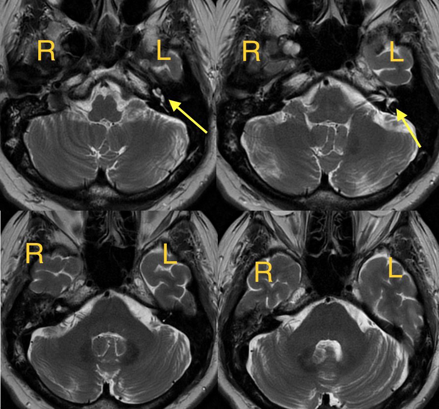 Imaging of Labyrinthitis Ossificans Etiology: Sequelae of chronic ...