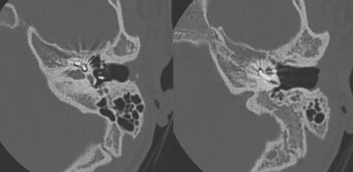 Imaging of Labyrinthitis Ossificans Etiology: Sequelae of chronic ...