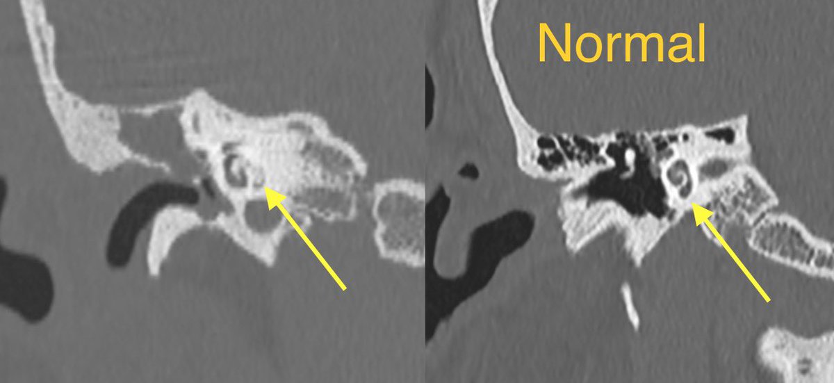 Imaging of Labyrinthitis Ossificans Etiology: Sequelae of chronic ...