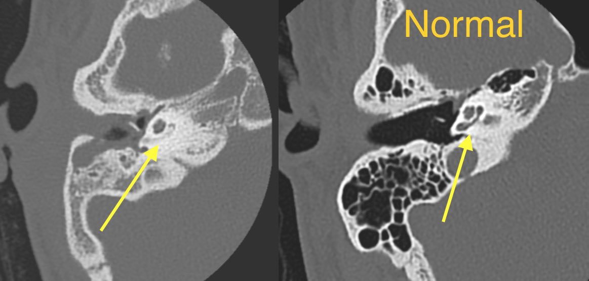Imaging of Labyrinthitis Ossificans Etiology: Sequelae of chronic ...