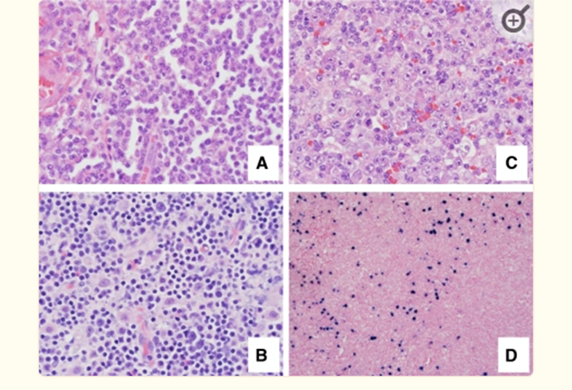 1/ Hi #MedTwitter Let's discuss about Post Transplant ...