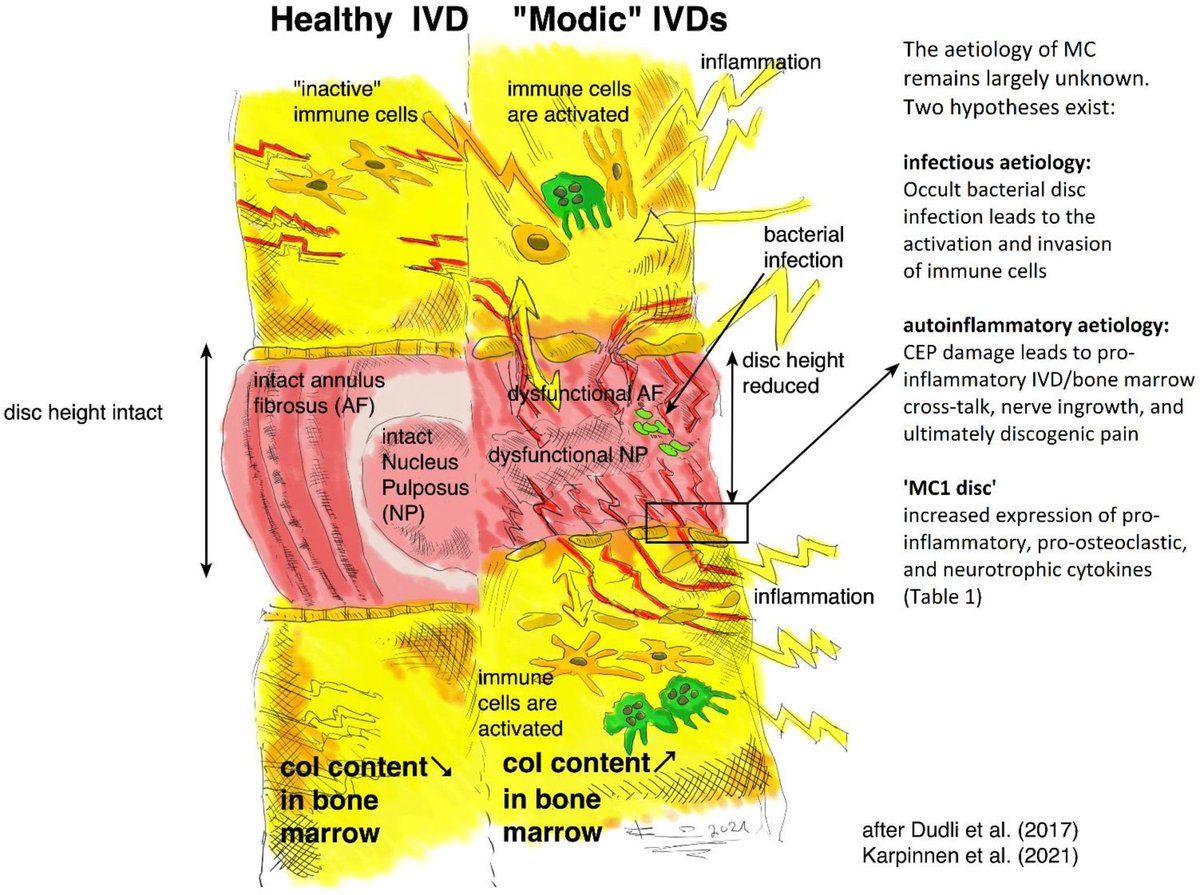 Physio Meets Science on Twitter: "Modic Changes 👇👇👇 https://pubmed.ncbi.nlm.nih.gov/35269863/"