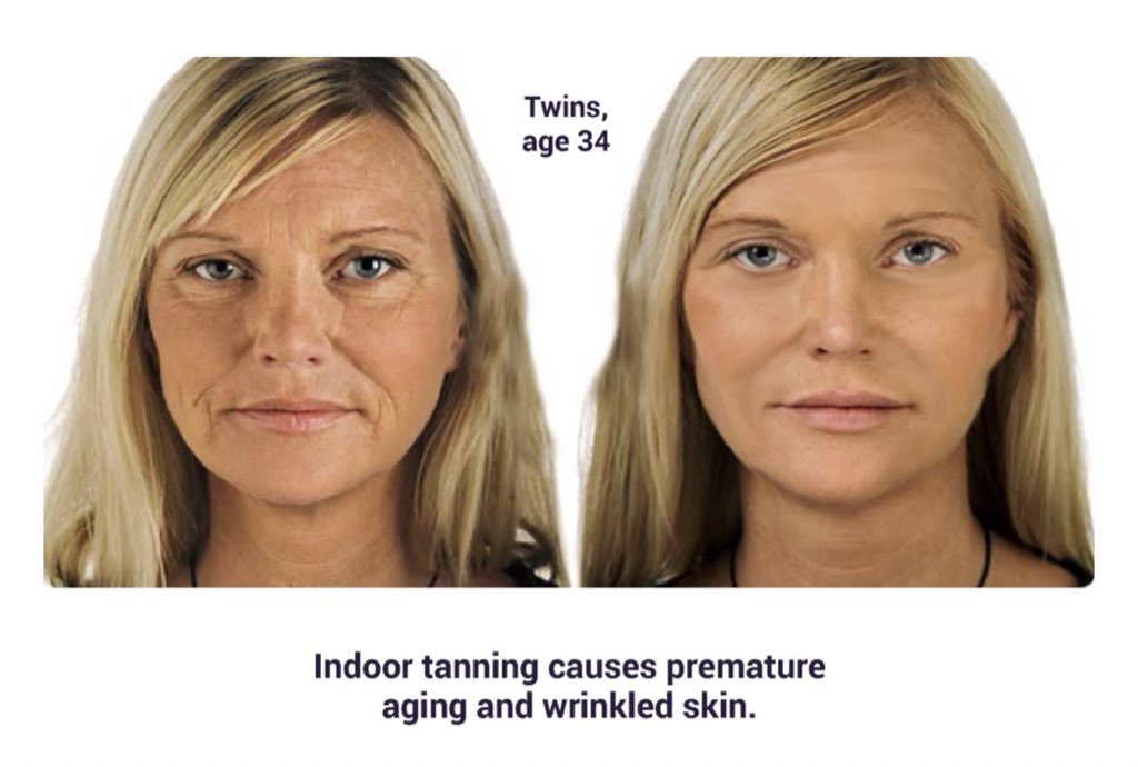 Premature Aging From Tanning