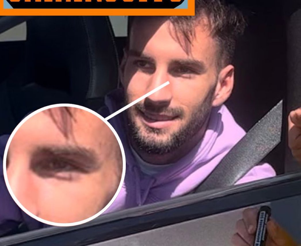 Madrid Zone On Twitter lex Baena s Eye Cheekbone 5 Days After madrid-zone-on-twitter-lex-baena-s-eye-cheekbone-5-days-after