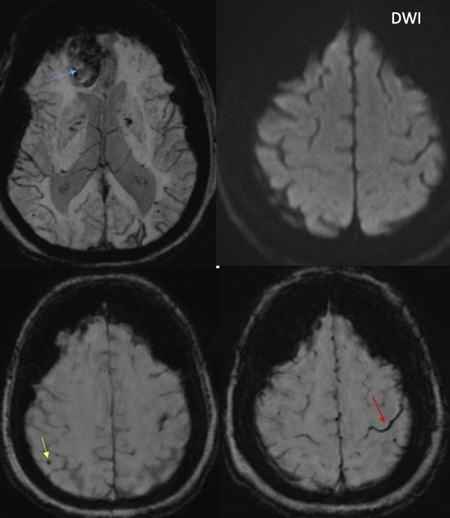 🧵TIA/minor stroke case🚑🧠 88F presents to ED w/ 30 min of R hand/arm ...