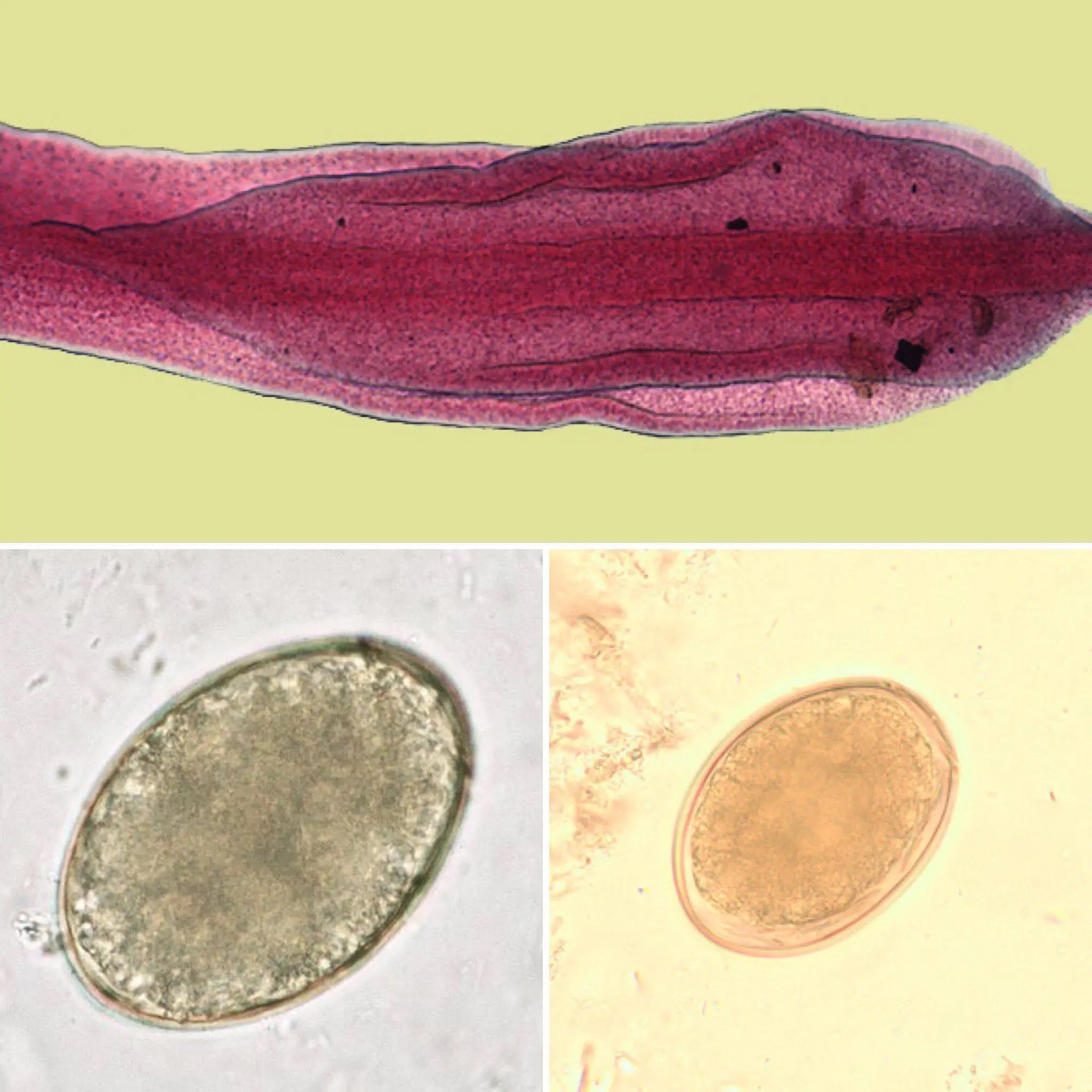 Diphyllobothrium Latum Worm