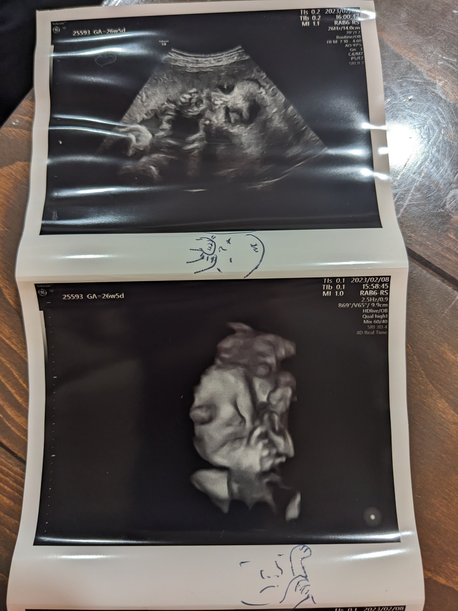 MADAO☂🎗😷 on Twitter: "人類はあまり赤さんの写真を載せてほしくないが、（赤さんも肖像権あるからね）エコー写真ならこっそり🤫 ご紹介します👶🏻 赤さんと便宜上呼んでたが、お腹 ...