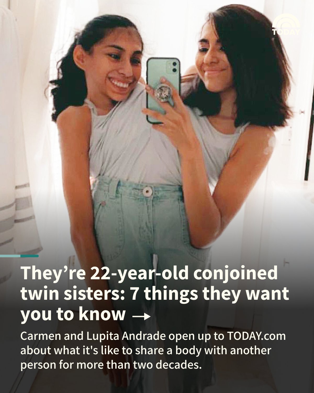 Conjoined Twins At The Pelvis