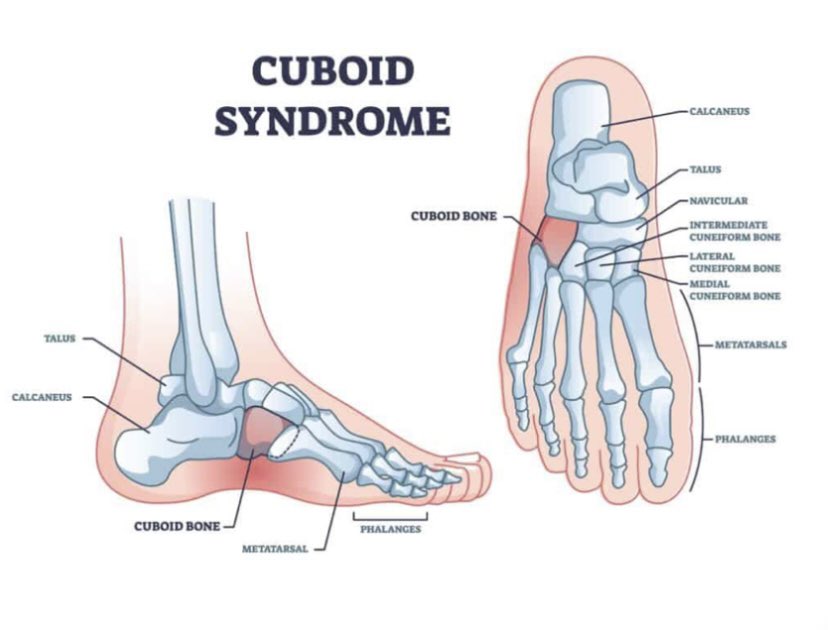 Cuneiform Bone Lateral