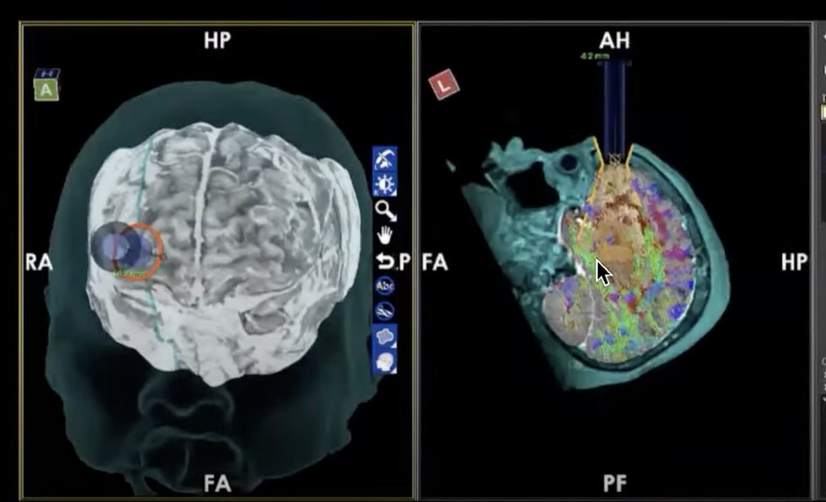 Two new surgical RCT's just released by @nejm @AANSNeuro If you're ...