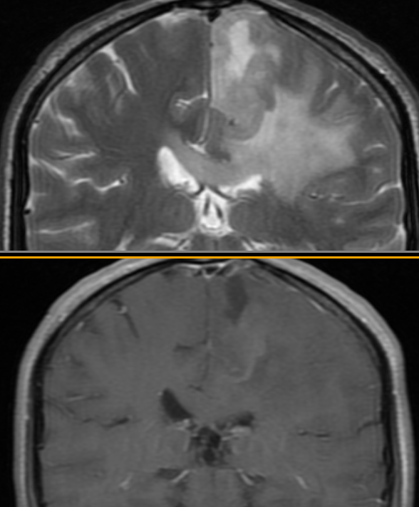 Stroke mimics & Gyral thickening, Clinico-radiological approach ...