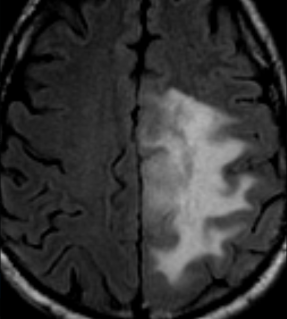 Stroke mimics & Gyral thickening, Clinico-radiological approach ...