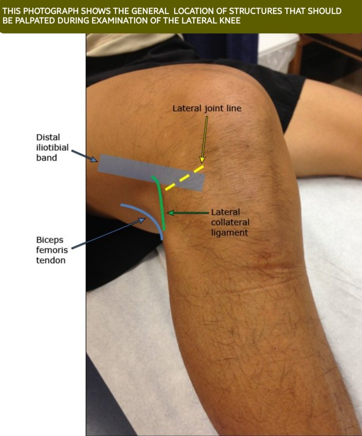 Head Of Fibula Palpation